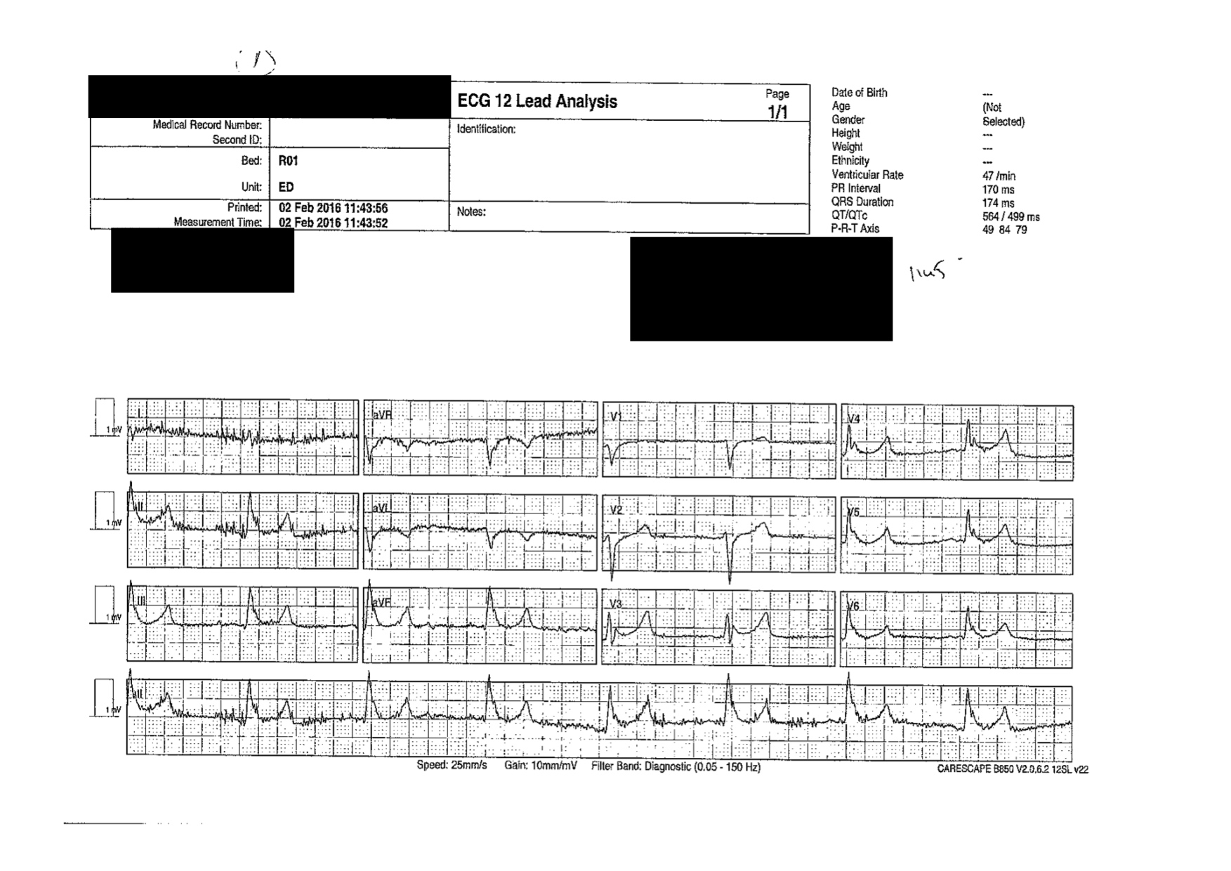 ECGs: Wide QRS - ED Guidelines